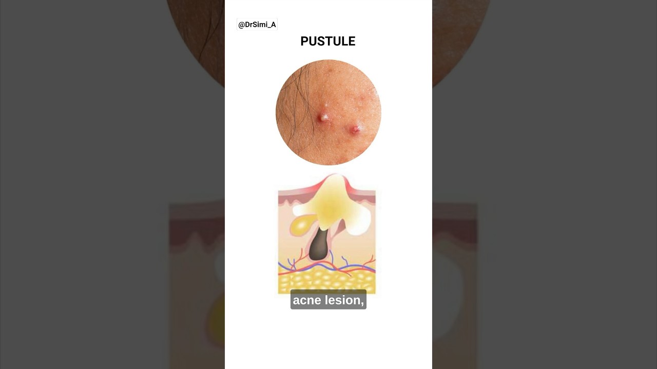 Pimple Pustule