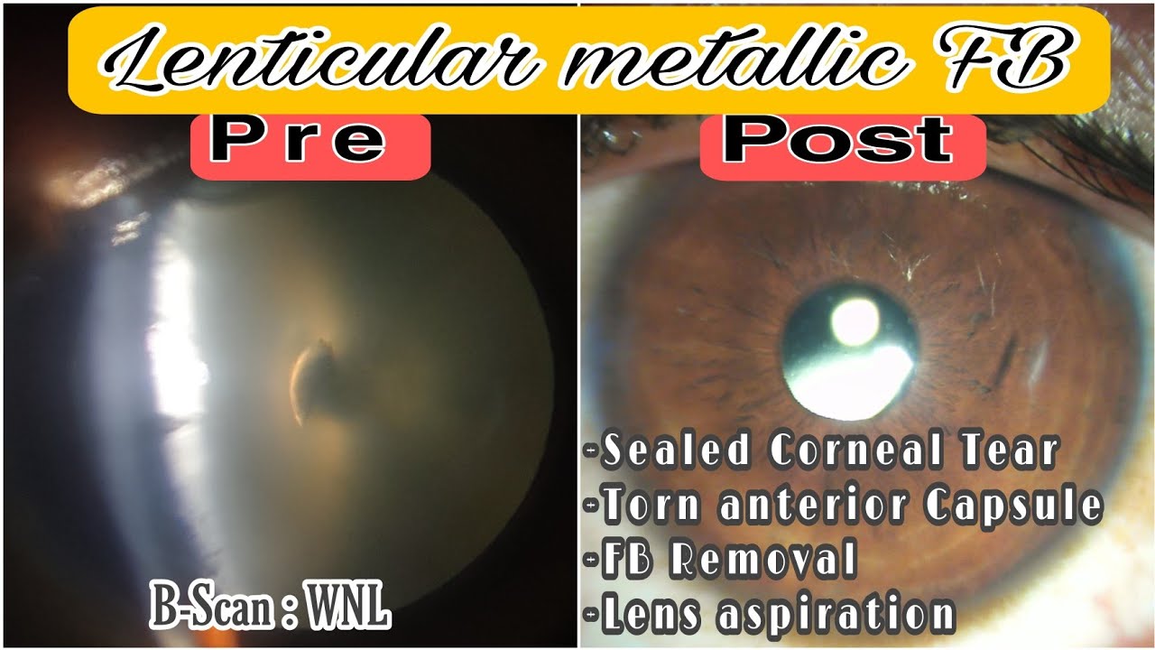#122 Intra Lenticular foreign body | Traumatic Total Cataract in young ...