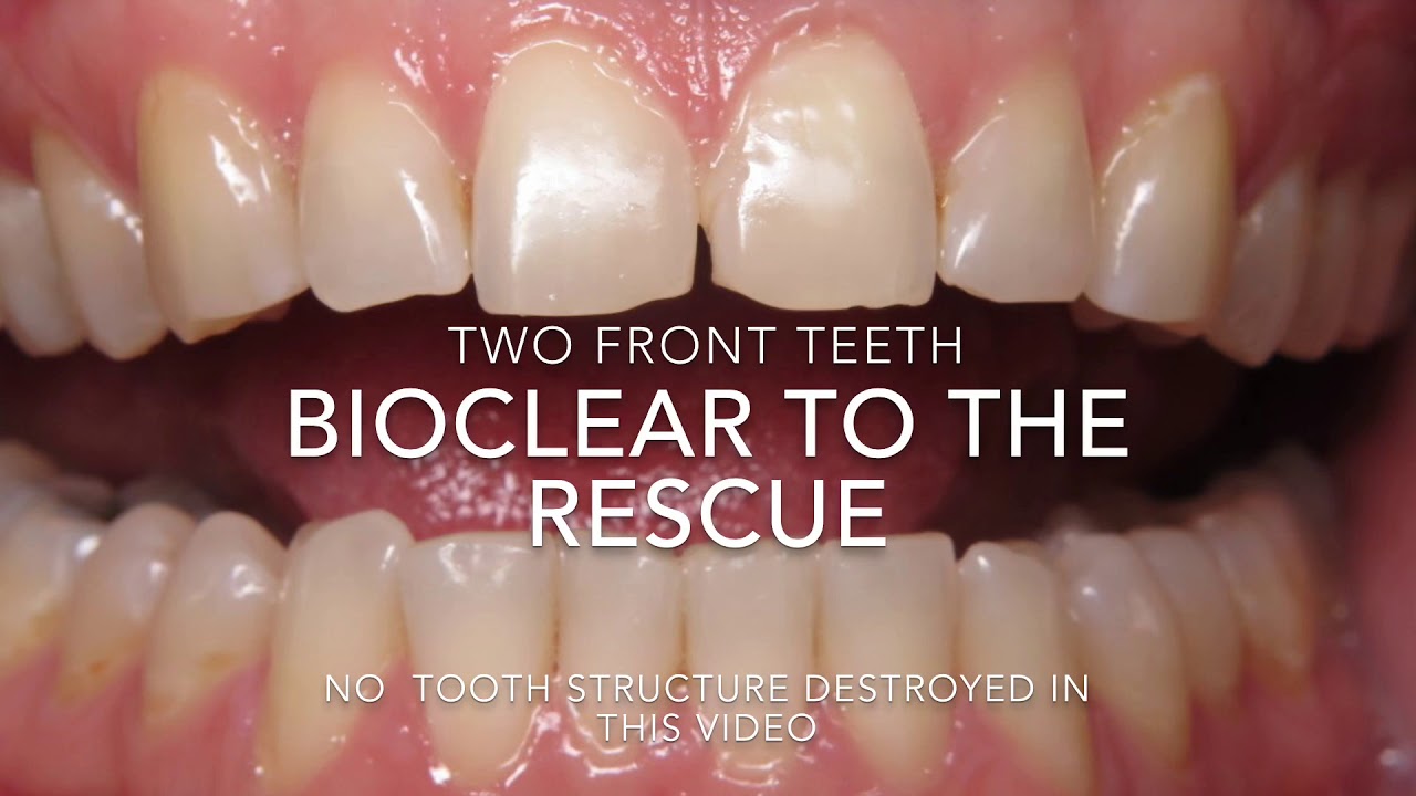 You don't need Porcelain Veneers: Bioclear to the Rescue! No tooth ...