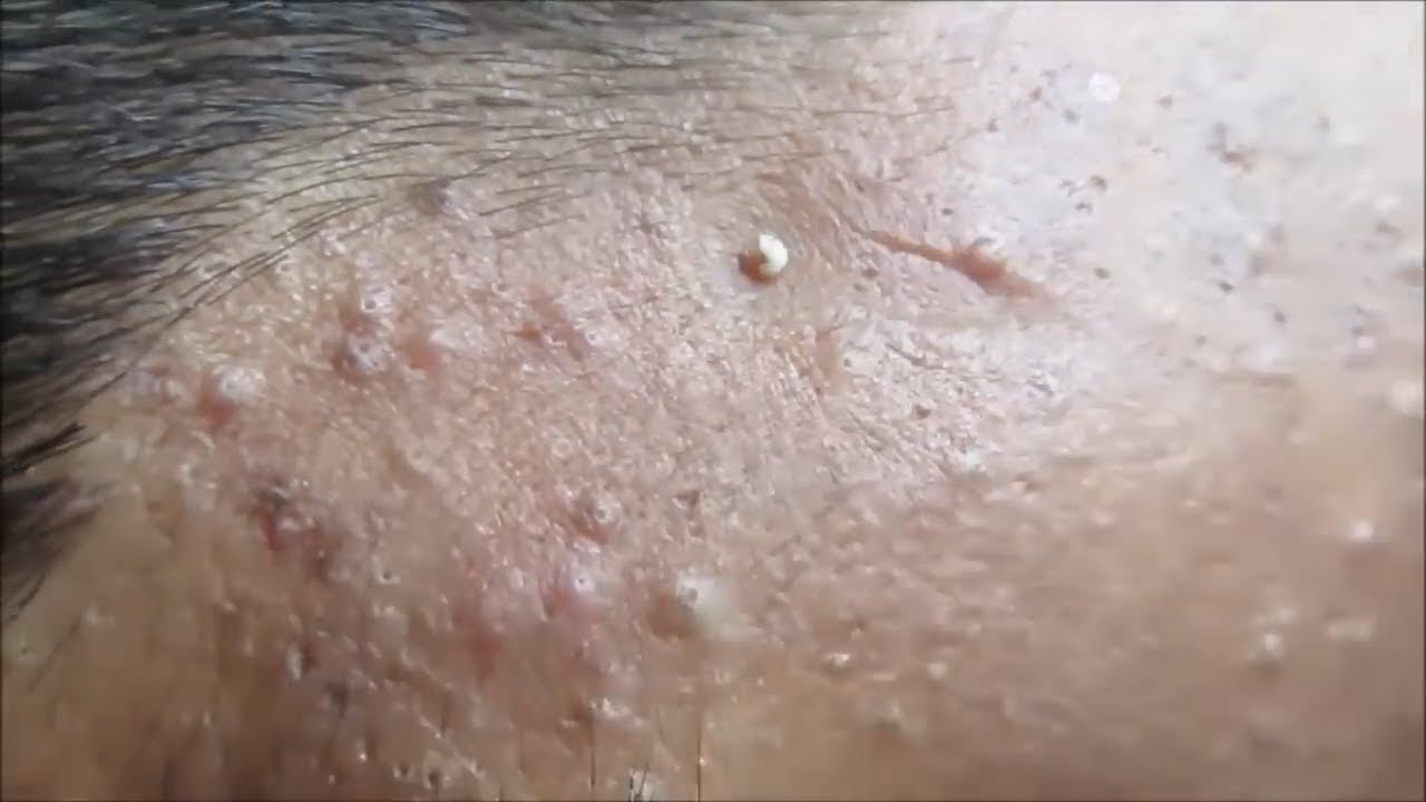 HOW TO REMOVE PIMPLE || HOW TO REMOVE BLACKHEADS AT HOME Part II - YouTube