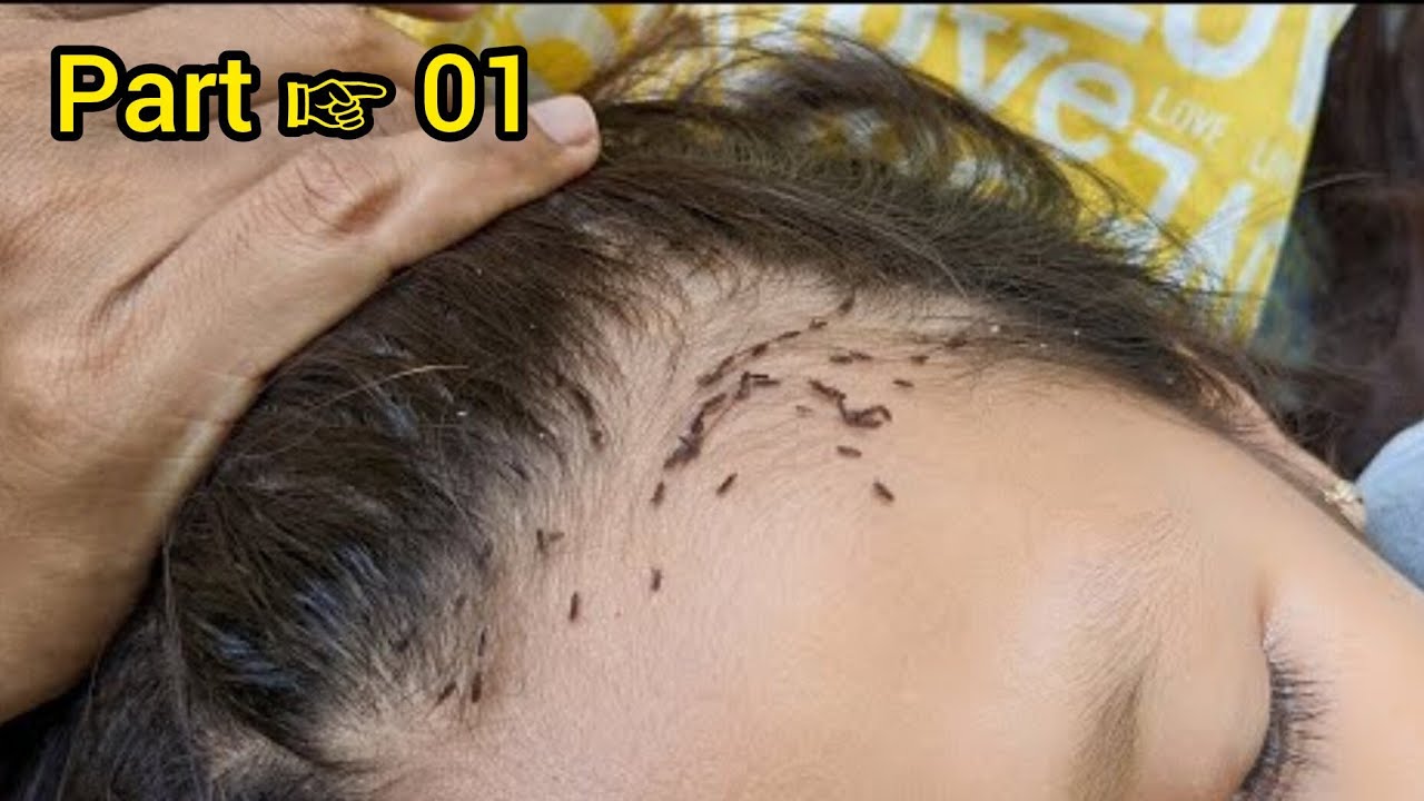 ASMR remove lice | picking lice | lice removal video | viral video ...
