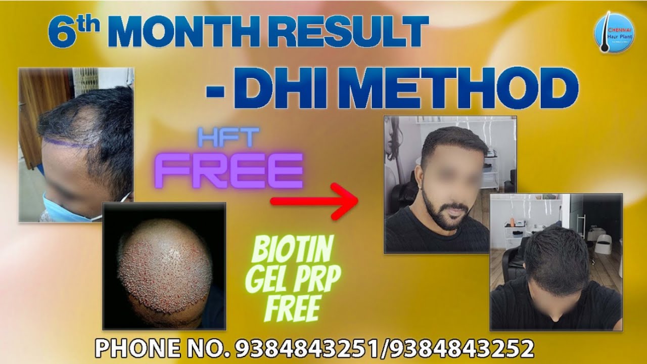 DHI-Method - 6th month Hair Growth result /Best hair transplant clinic ...