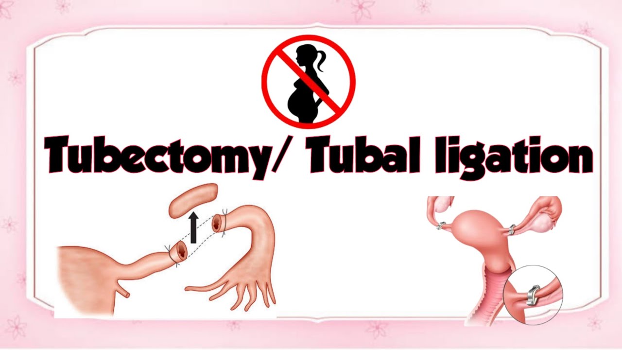 Tubectomy/ Tubal ligation: Permanent method of sterilization - YouTube