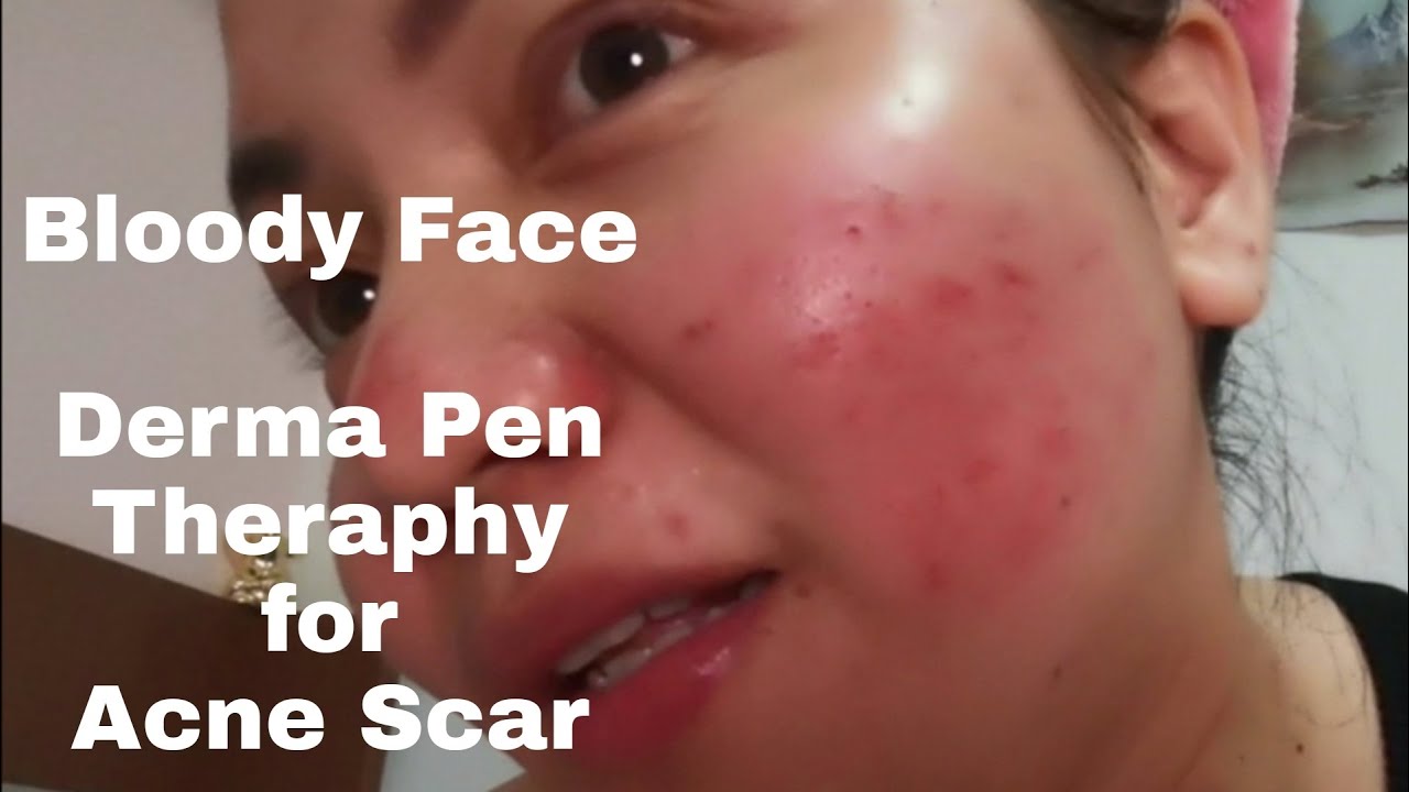 Tanggal ang Butas ng Mukha! Derma Pen! - YouTube