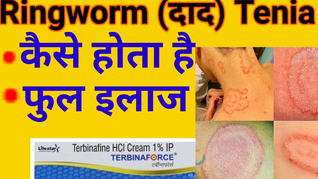 Ringworm in hindi// दाद का इलाज// Tenia capitis, Tenia corporis ...