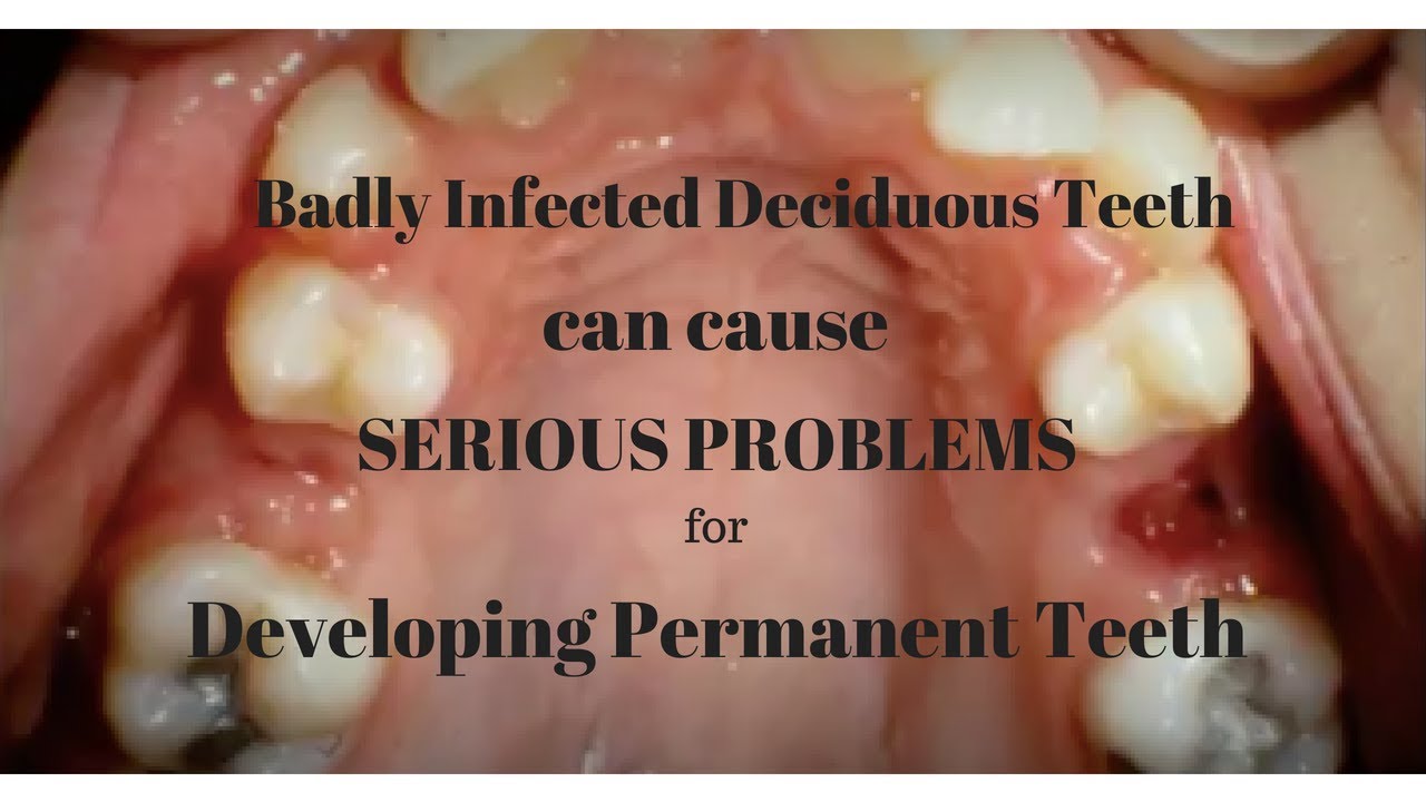 Endodontics on Badly Infected Deciduous Teeth can cause SERIOUS PROBLEM ...