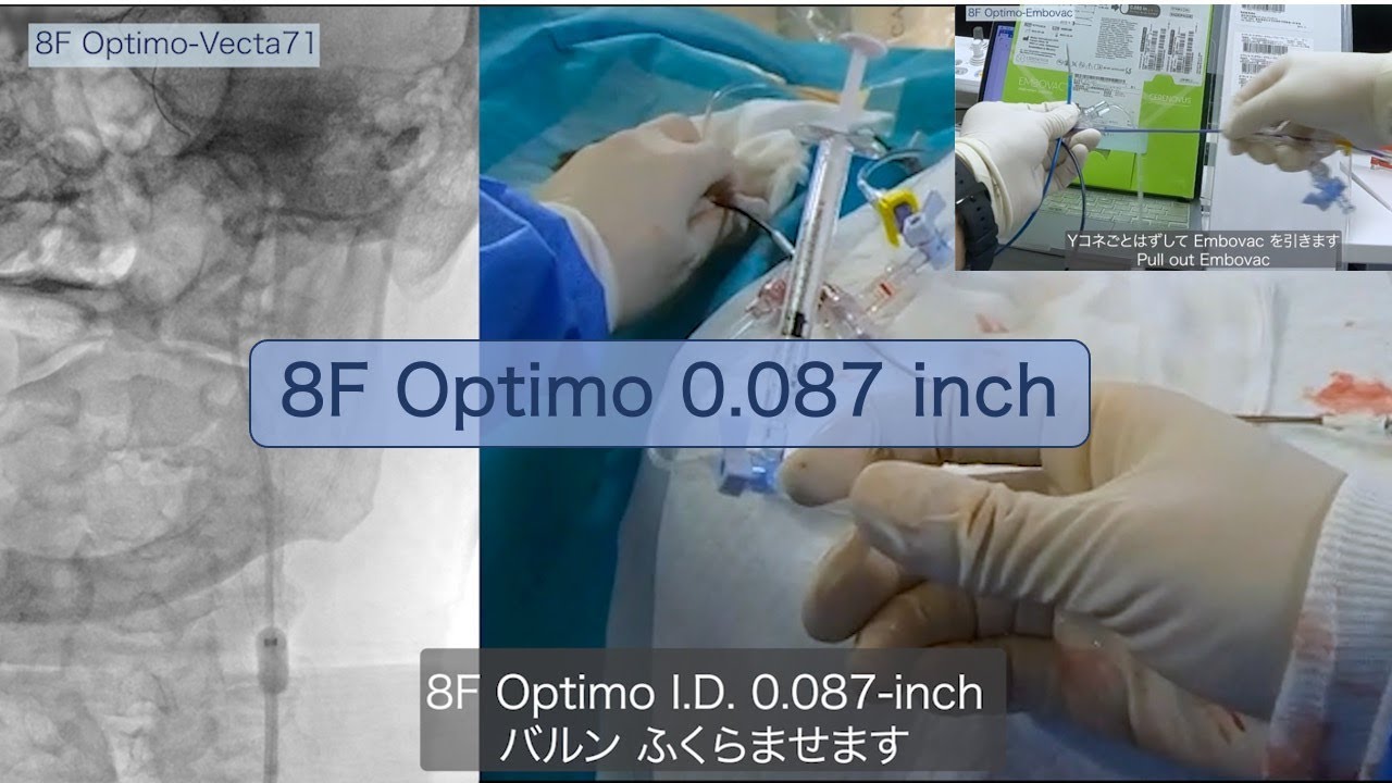 8F Optimo balloon guide catheter 0.087 inch 内腔広くなった 吸引と中間カテ するする通る - YouTube