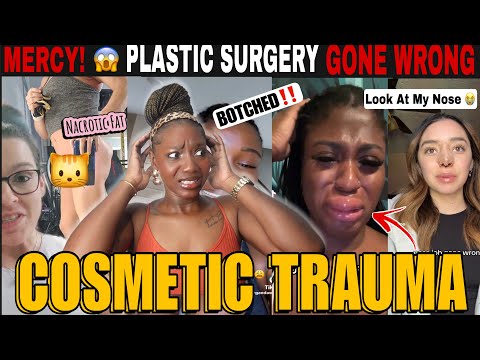 PLASTIC SURGERY GONE WRONG! Botched BBL, Fillers & Cosmetic Trauma ...