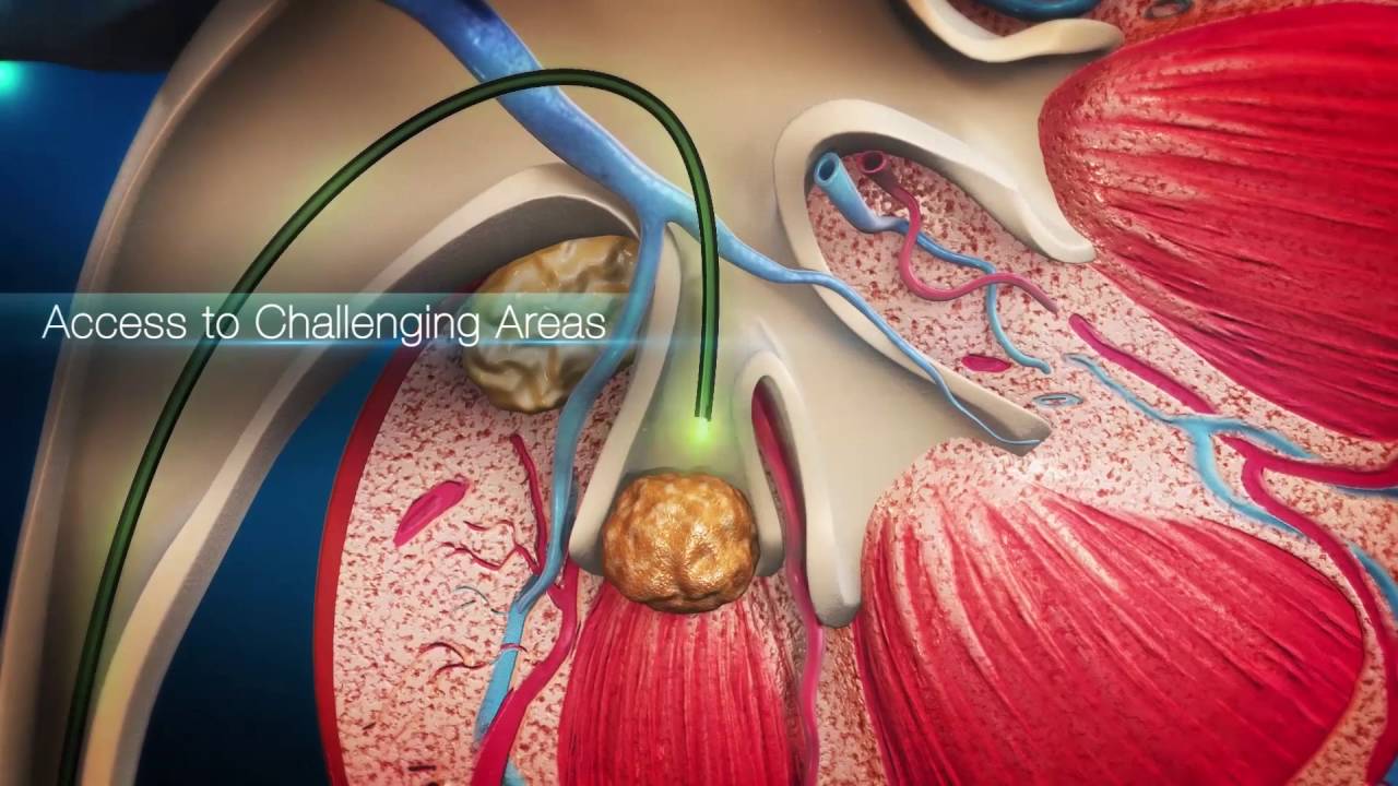 vaporisation laser de calculs rénaux - YouTube