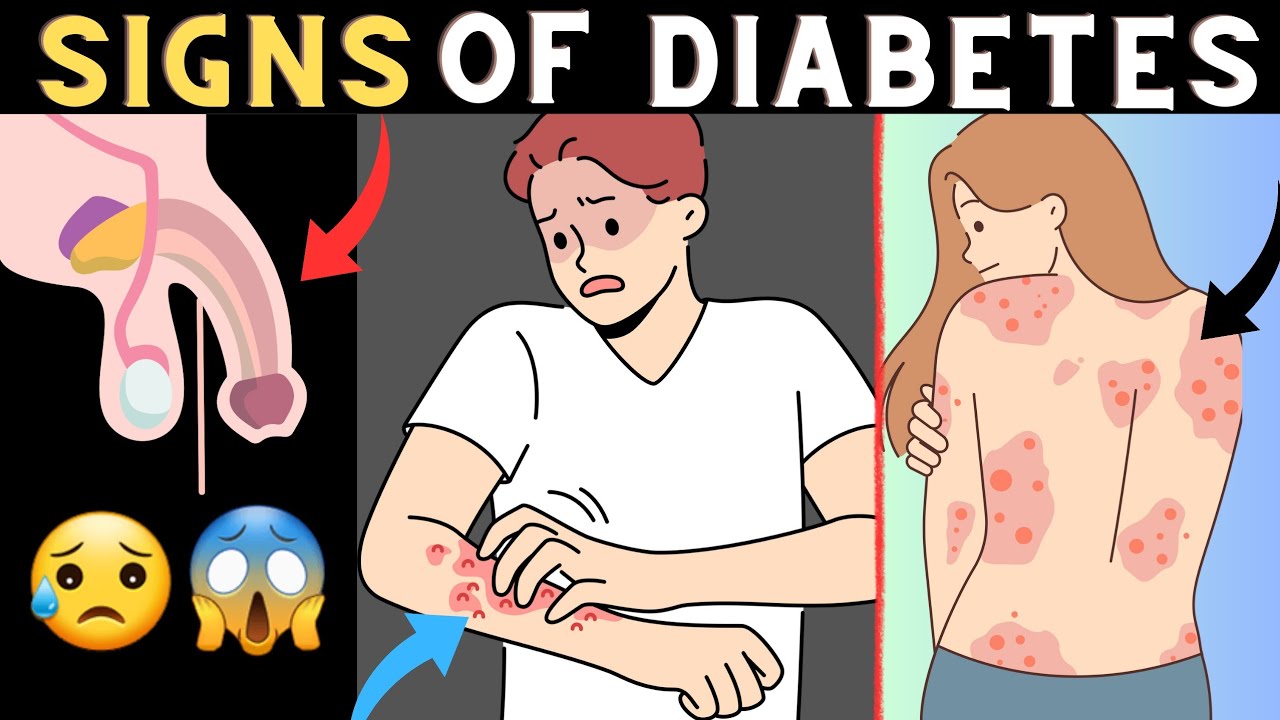 Dangerous Signs of Diabetes : 10 Signs That Most People Ignore - YouTube