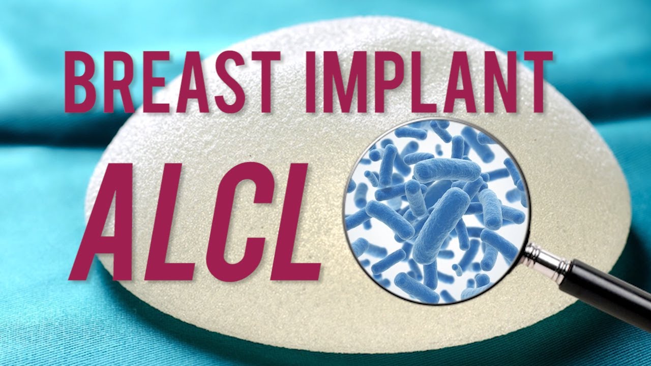 With Breast Implant Related ALCL, Trust the Experts - YouTube