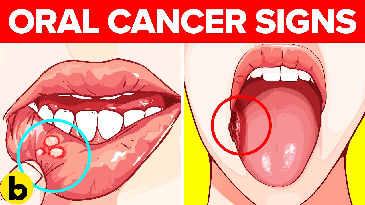 Warning Signs Of Oral Cancer Symptoms Risk Factors And Treatment
