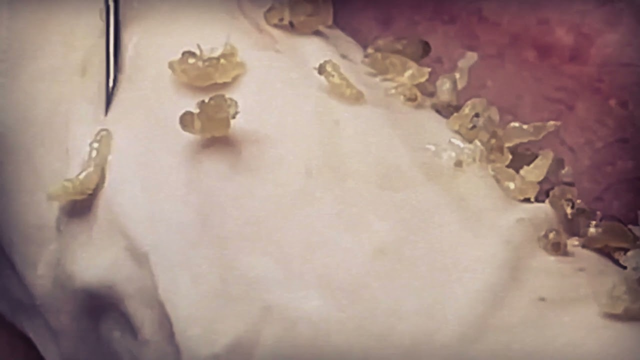 Top Pimple TV #76, remove acne from face - YouTube