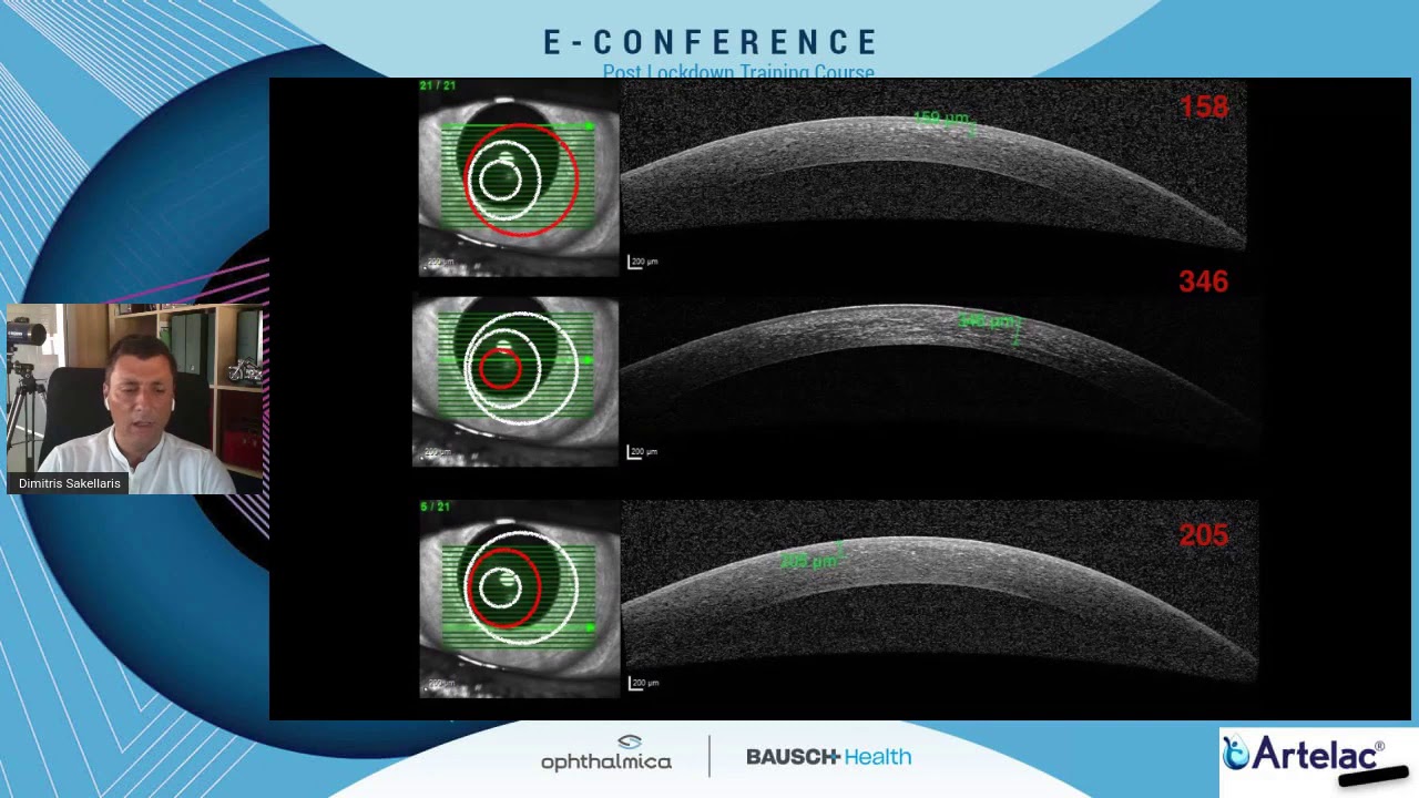 CXL treatment strategies & therapeutic protocols in eyes with ...