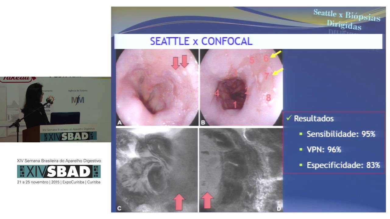 Diagnóstico da displasia protocolo de Seattle x biópsias dirigidas no ...
