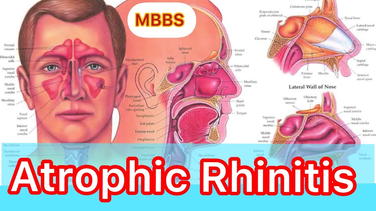 Atrophic Rhinitis - YouTube