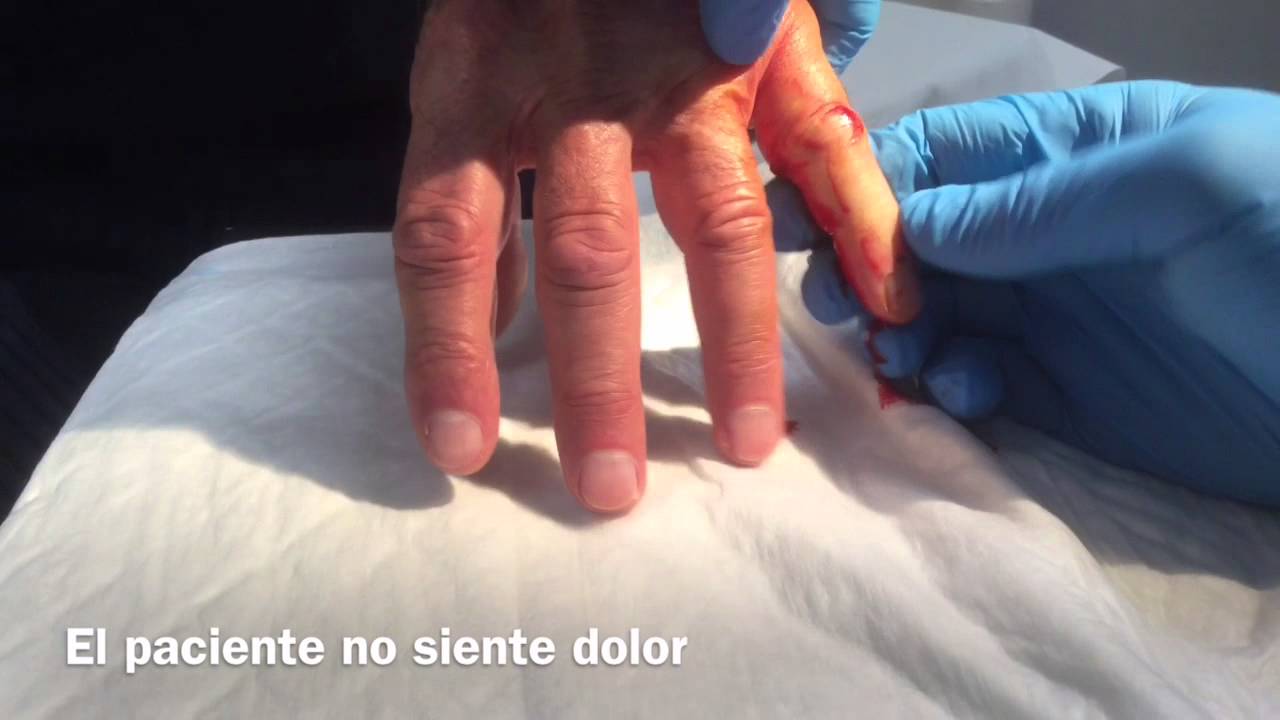 Subluxación De La Articulación Del Dedo