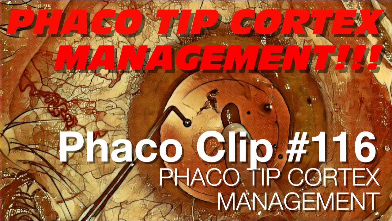 Phaco Clip #116 - Phaco Tip Cortex Management - YouTube