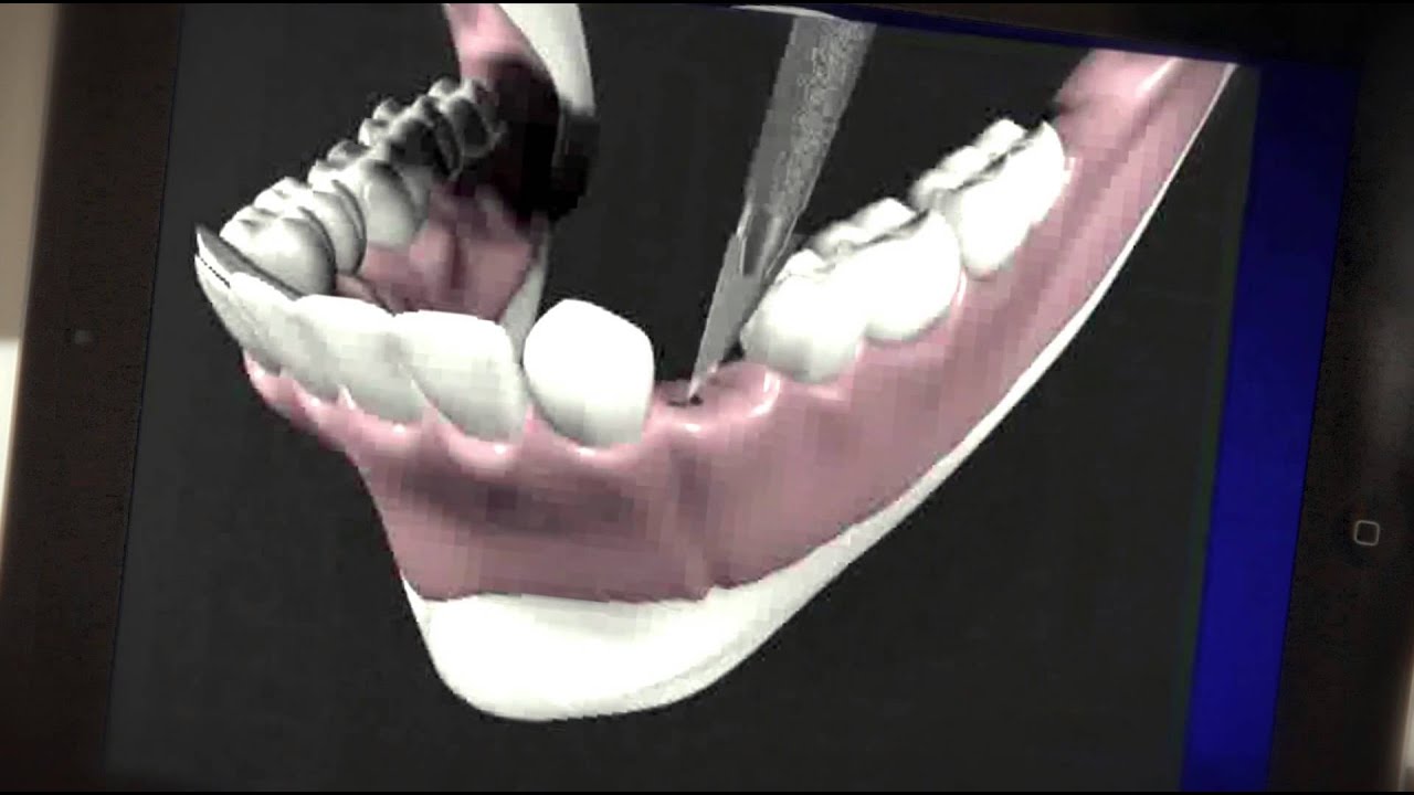 2. Behandlungsschritt: Implantat setzen - YouTube