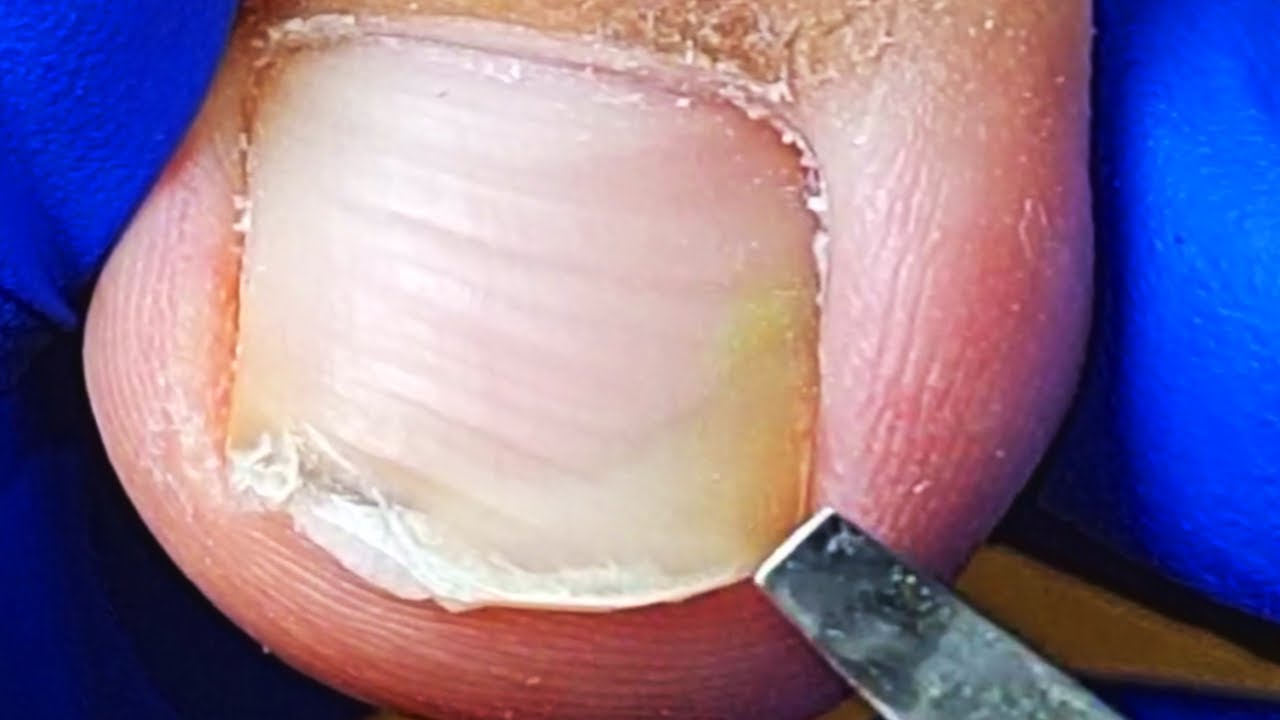 Seemingly ordinary nails digging deep into the flesh of the toes【Xue ...