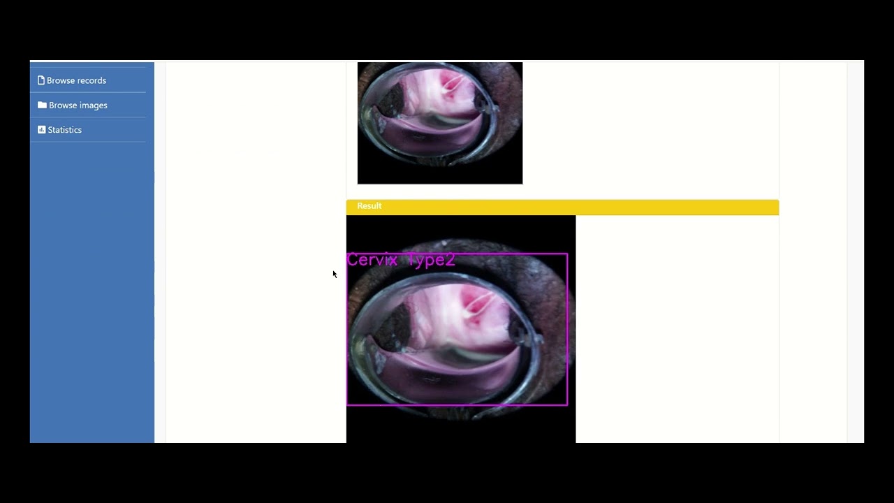 Cervix Type Classification Using Yolo Object Detection Algorithm 5355