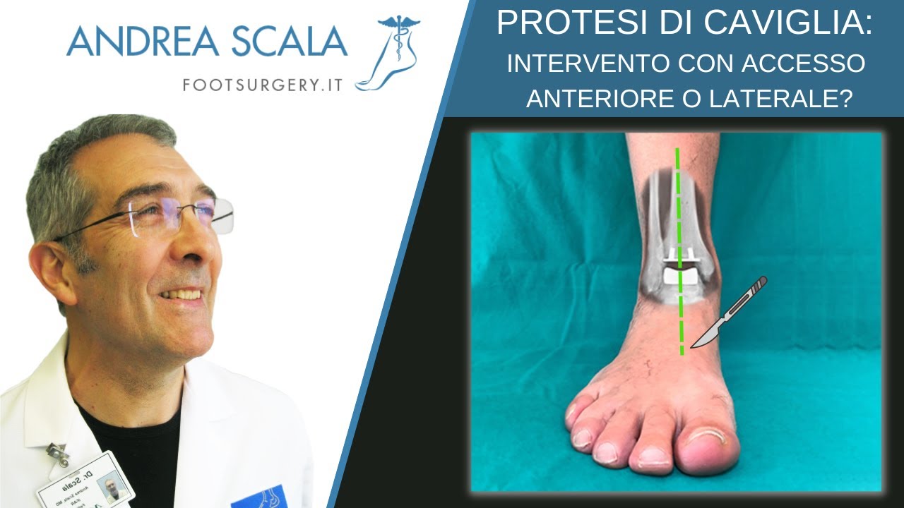Protesi di caviglia: intervento con accesso anteriore o laterale ...