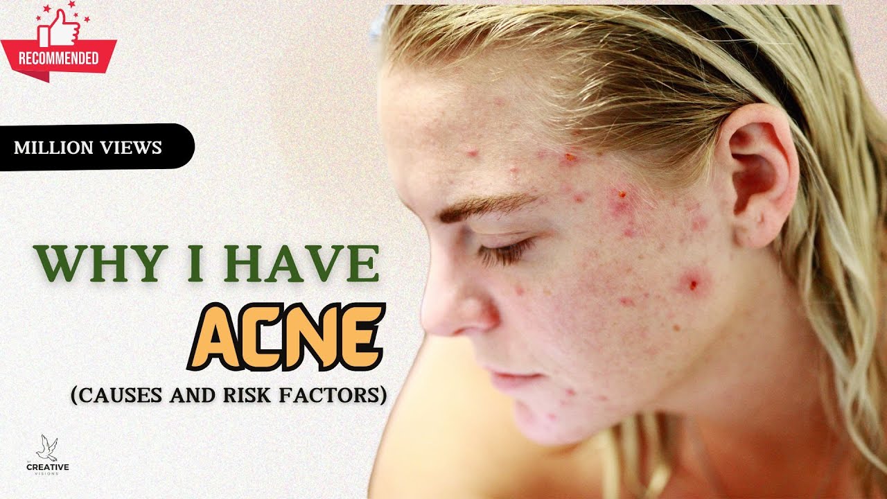 most common causes and risk factors for Acne by my creative vision # ...