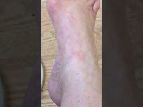 5/22/19 My right foot swollen in frequencies - YouTube