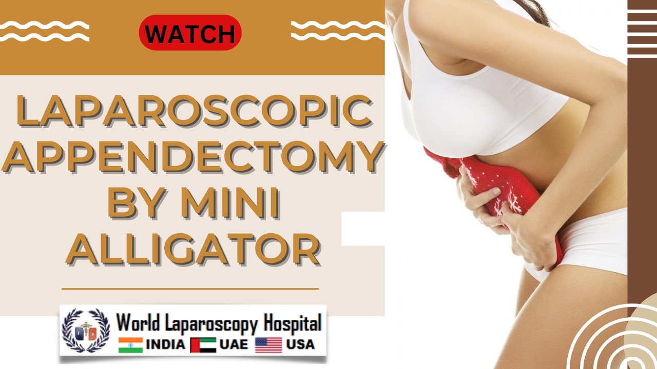 Laparoscopic Appendectomy by Mini Alligator - YouTube