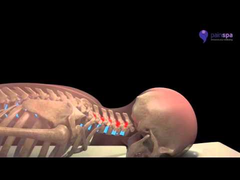 Cervical facet joint injections