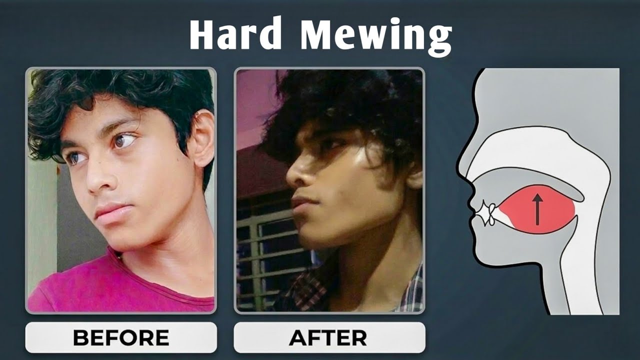 What Is Hard Mewing and How To Apply It? - YouTube