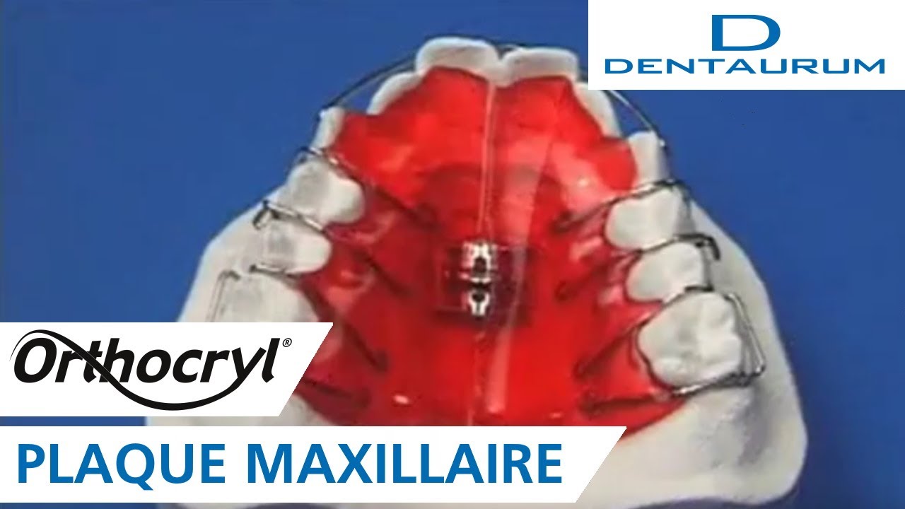 Orthocryl® - plaque maxillaire réalisée par saupoudrage (appareil ...