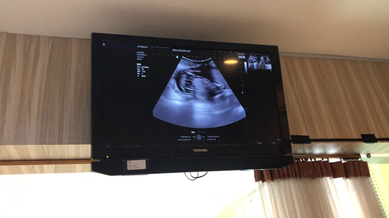 USG 2D & 4D usia kandungan 21 minggu.. - YouTube