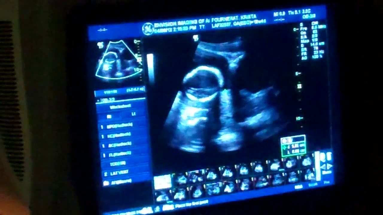 5 Month Ultrasound for our Second Baby - Jacques - YouTube
