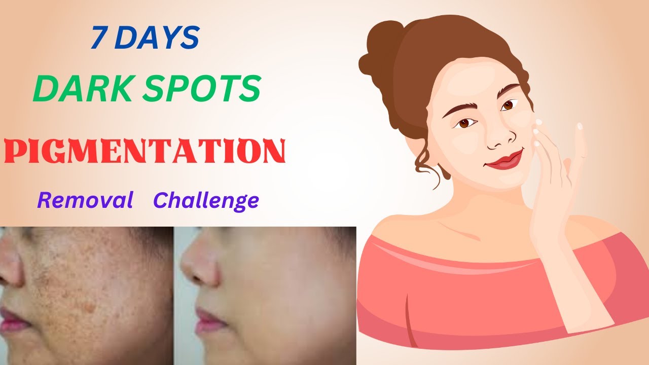 Remove dark spots & pigmentation || Skin Transformation || Spotless ...