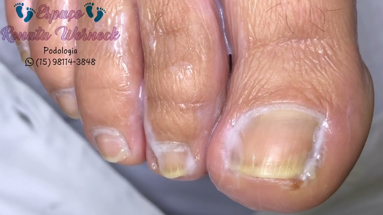 Manutenção e explicações sobre onicomicose - YouTube
