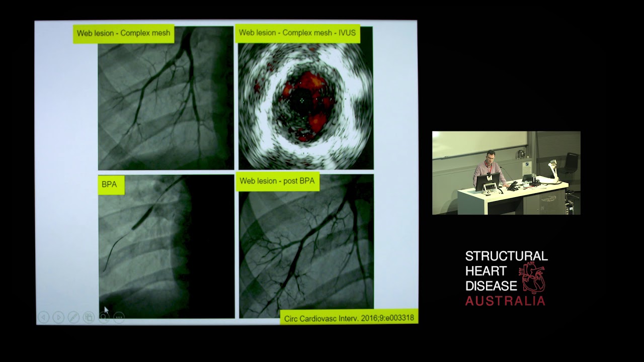 Balloon Pulmonary Angioplasty for CTEPH - Dr David Boshell - YouTube