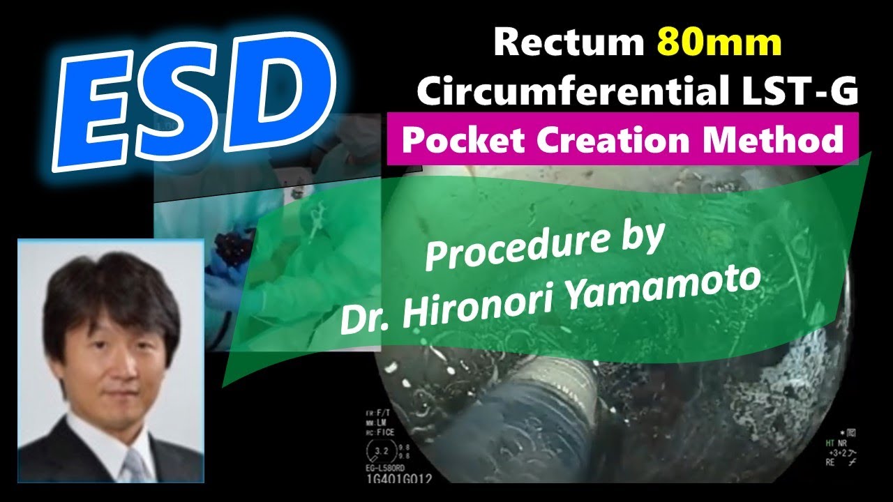 Pocket creation method -Dr. Hironori Yamamoto- - YouTube