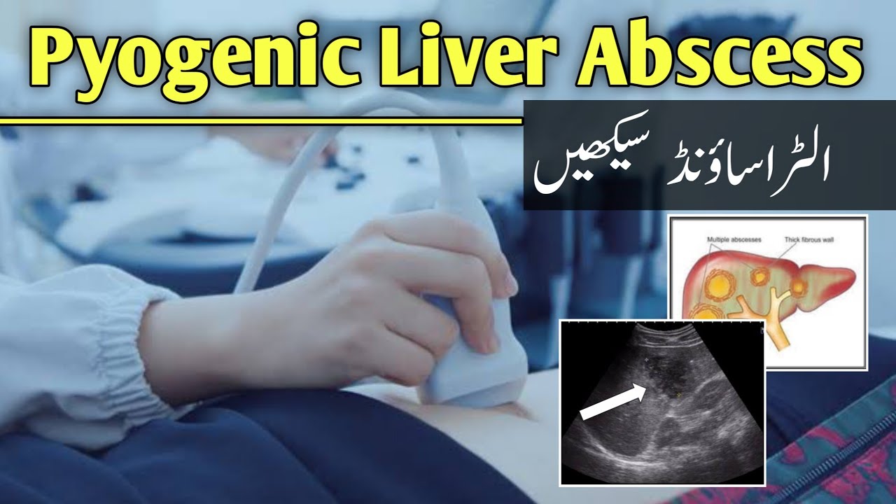 Pyogenic Liver Abscess in Ultrasound by Dr Ali Waqar - YouTube