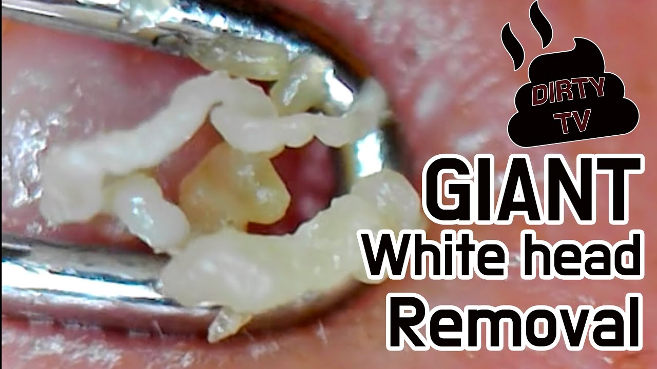 #6 Pull out Blackheads / Whiteheads Close up 300X - Blackheads Removal ...