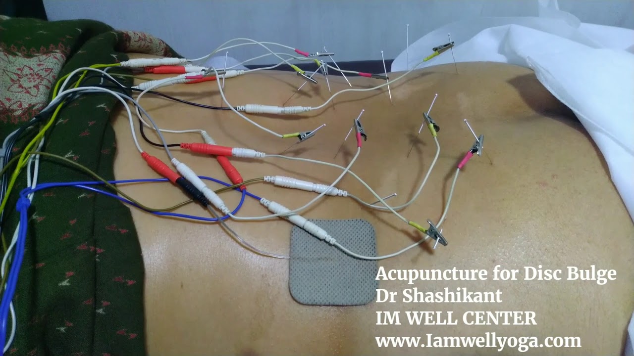Disc Bulge Acupuncture - Dr Shashikant - YouTube