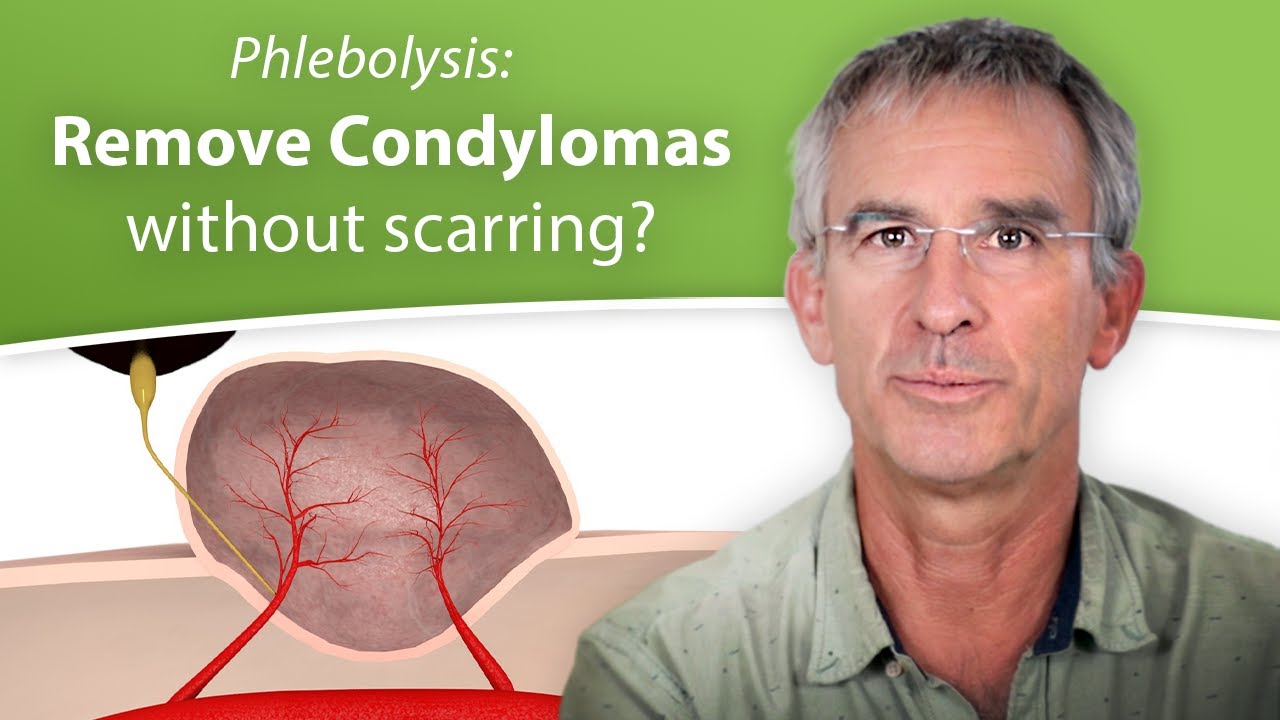 Condylomas and genital warts - treatment with phlebolysis? #health ...
