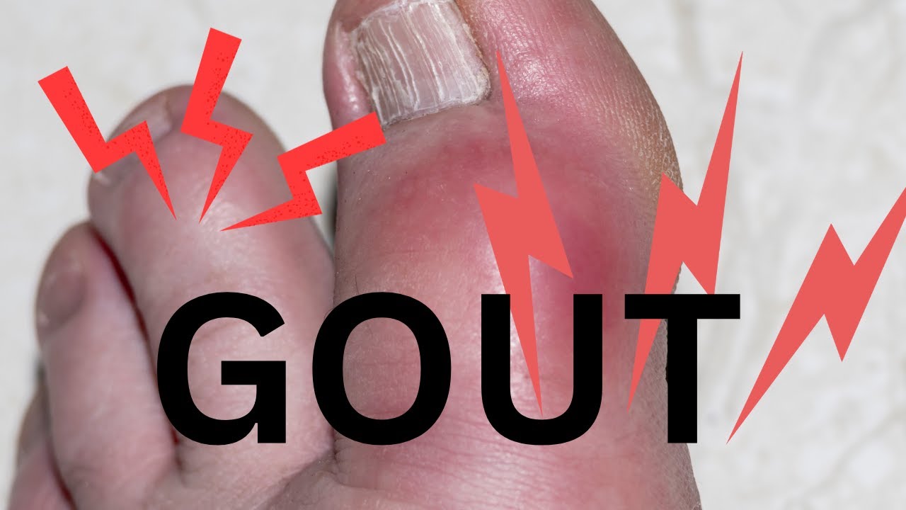 Gout - YouTube