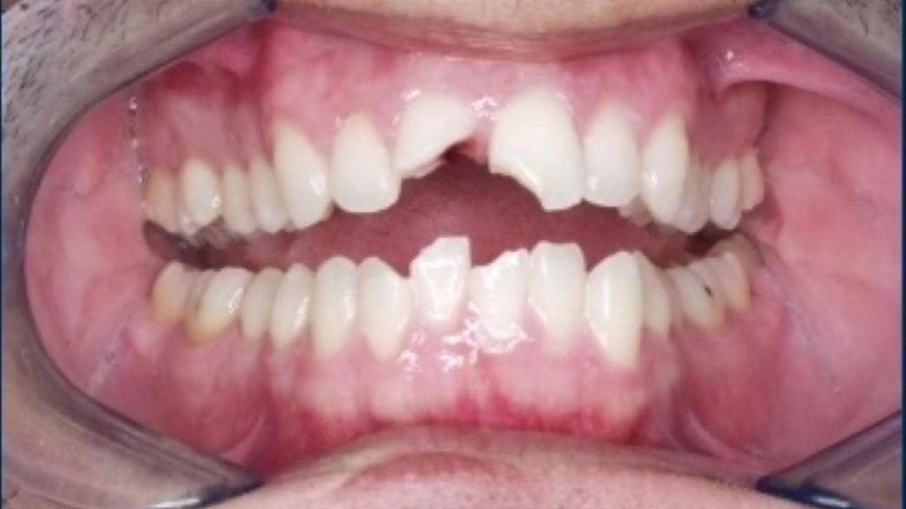 SOAT DIENTES PARTIDOS, DIENTES QUEBRADOS EN ACCIDENTES DE MOTOS - YouTube