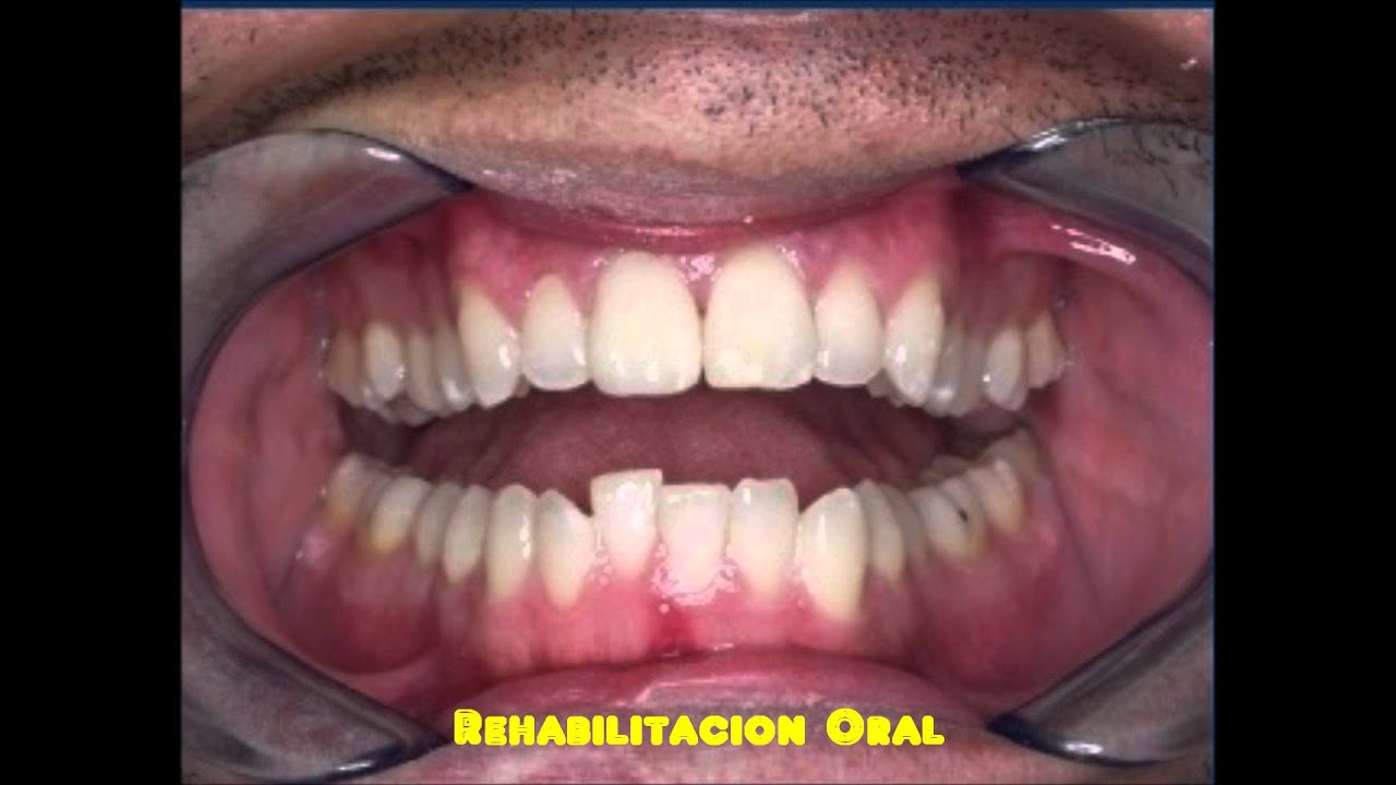 SOAT DIENTES PARTIDOS, DIENTES QUEBRADOS EN ACCIDENTES DE MOTOS - YouTube
