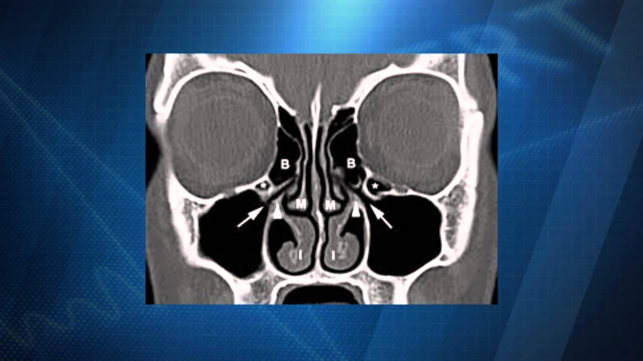 Medical Montana: CT review for chronic sinusitis patients - YouTube
