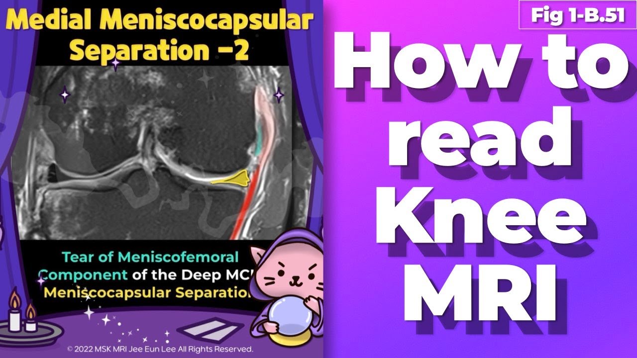 (Fig 1-B.51) Medial and Lateral Meniscocapsular Separations - YouTube