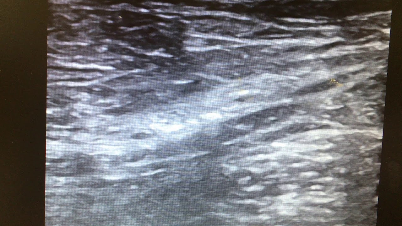 Genitofemoral Nerve Block - YouTube