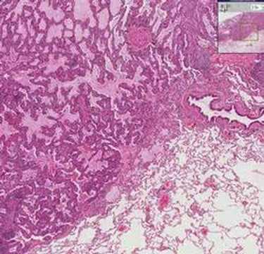 Histopathology Lung--Bronchiolo-alveolar carcinoma - YouTube