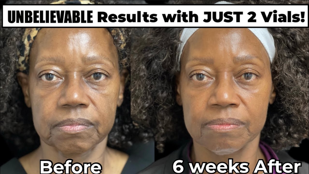 Incredible Sculptra Before And After In Only 6 Weeks YouTube